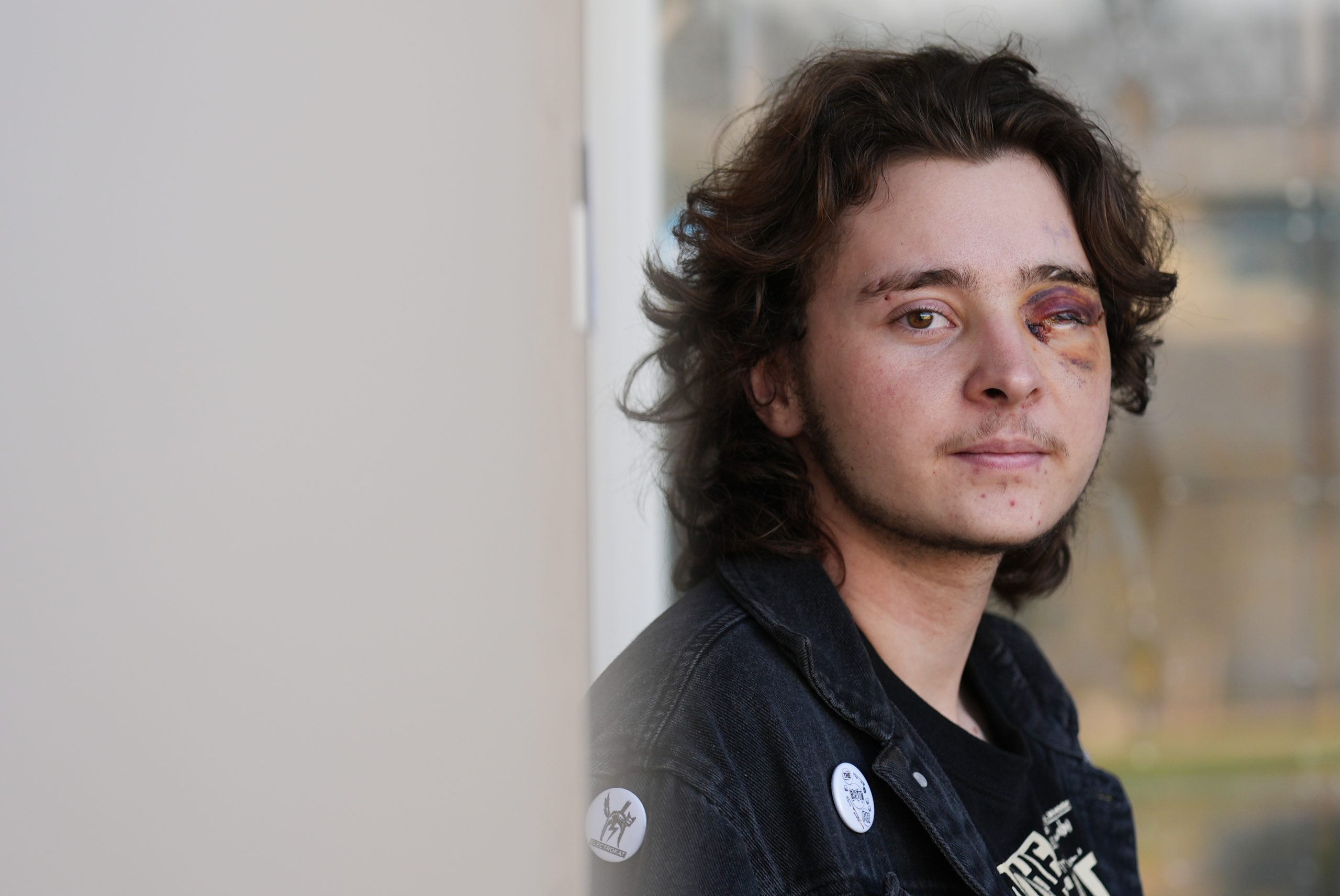 California protester left blind in one eye is among string of violent ...